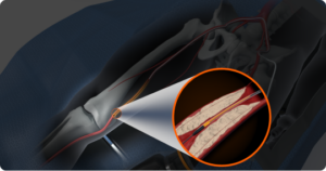 Pulse IVL™ - AVS Pulse, Inc