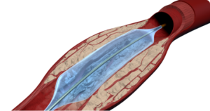 Pulse IVL™ - AVS Pulse, Inc