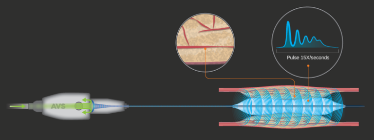 Mechanism of Action - AVS Pulse, Inc