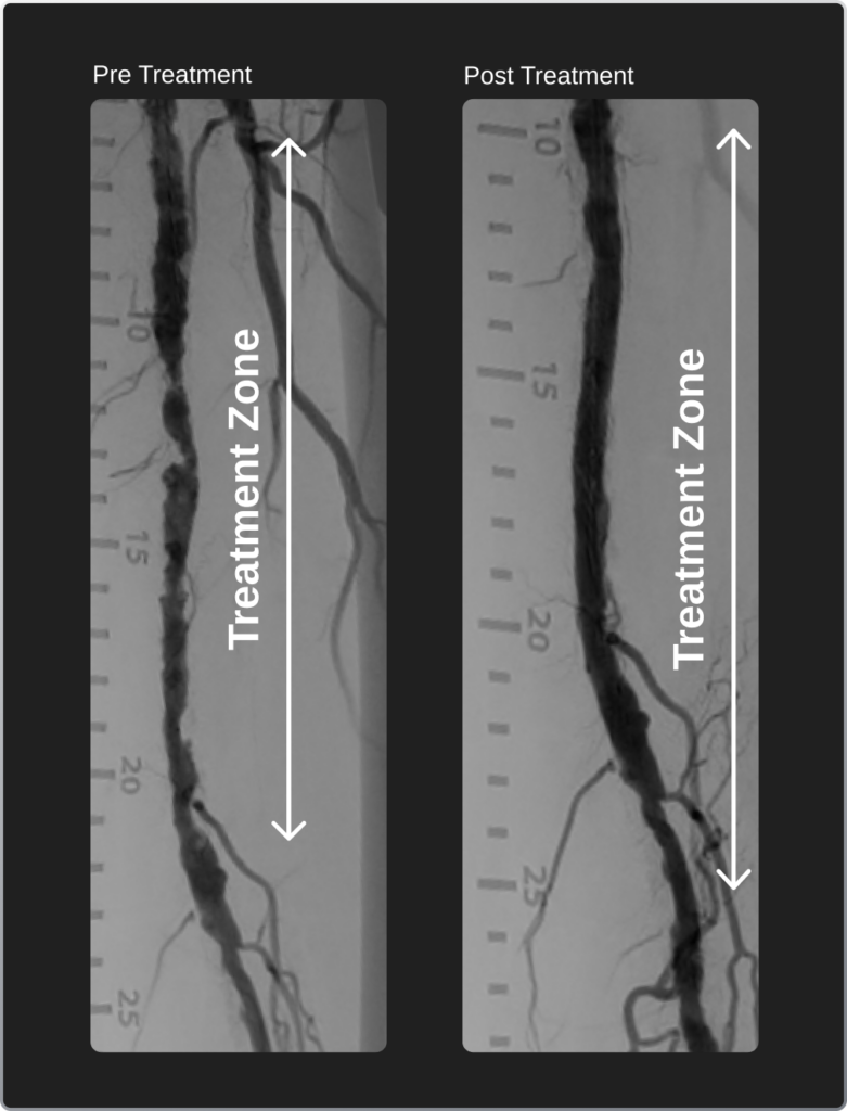 Peripheral Clinical Evidence - AVS Pulse, Inc